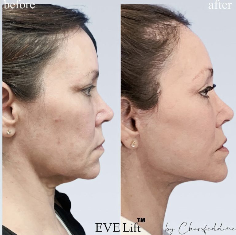 EVE Lift™️ Facelift Dr. Ali Charafeddine | South Florida Plastic Surgeon