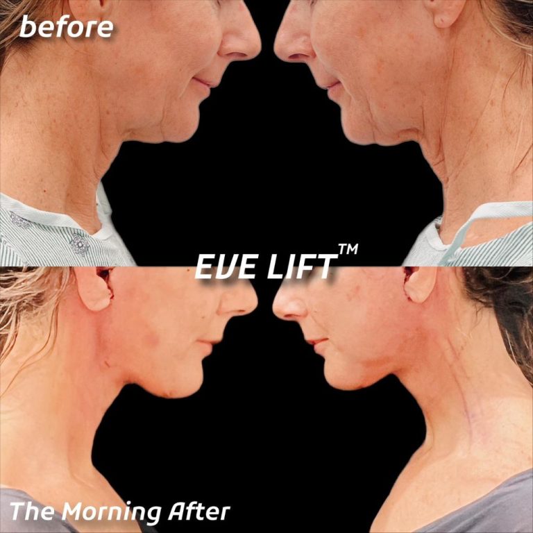 EVE Lift™️ Facelift Dr. Ali Charafeddine | South Florida Plastic Surgeon