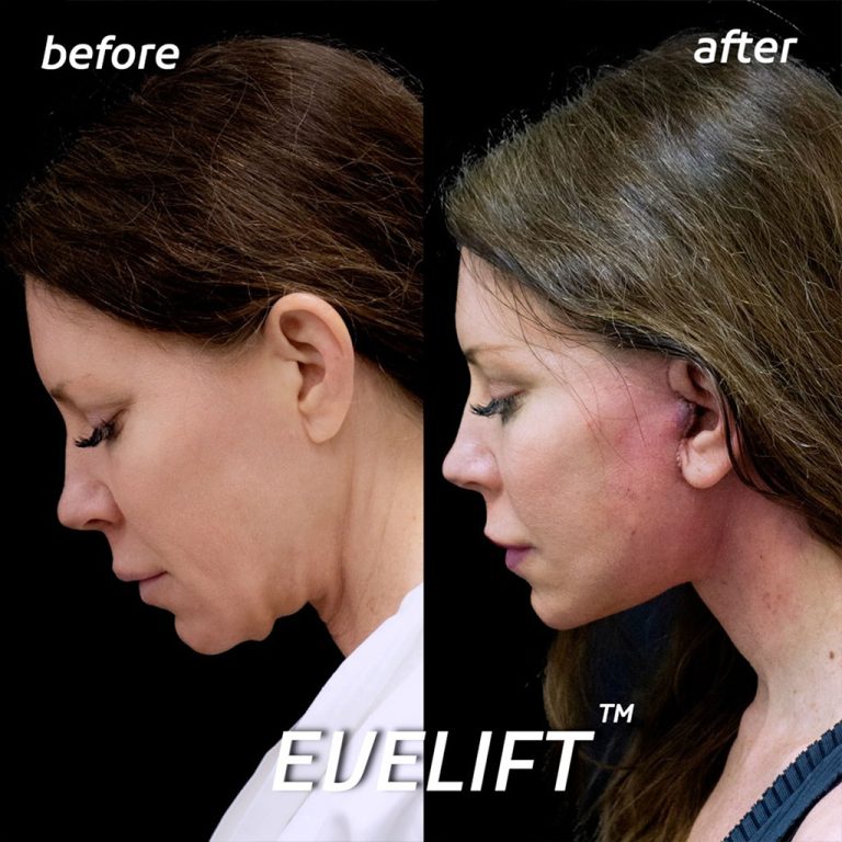 EVE Lift™️ Facelift Dr. Ali Charafeddine | South Florida Plastic Surgeon