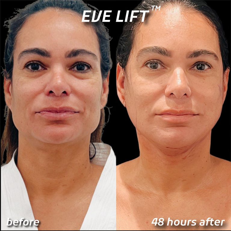 EVE Lift™️ Facelift Dr. Ali Charafeddine | South Florida Plastic Surgeon