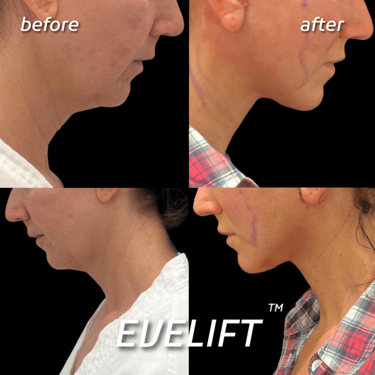 EVE Lift™️ Facelift Dr. Ali Charafeddine | South Florida Plastic Surgeon