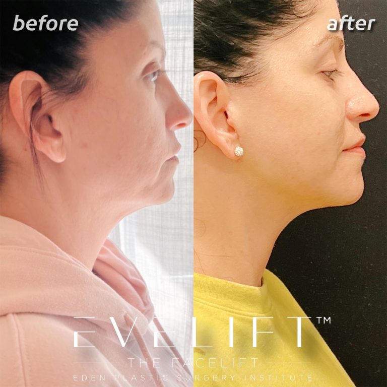 EVE Lift™️ Facelift Dr. Ali Charafeddine | South Florida Plastic Surgeon