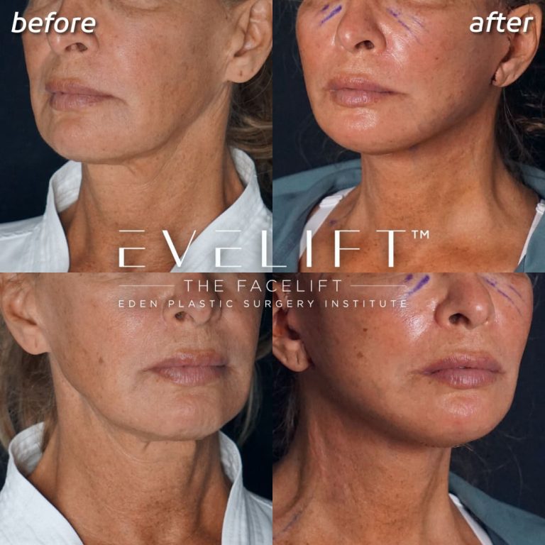 EVE Lift™️ Facelift Dr. Ali Charafeddine | South Florida Plastic Surgeon