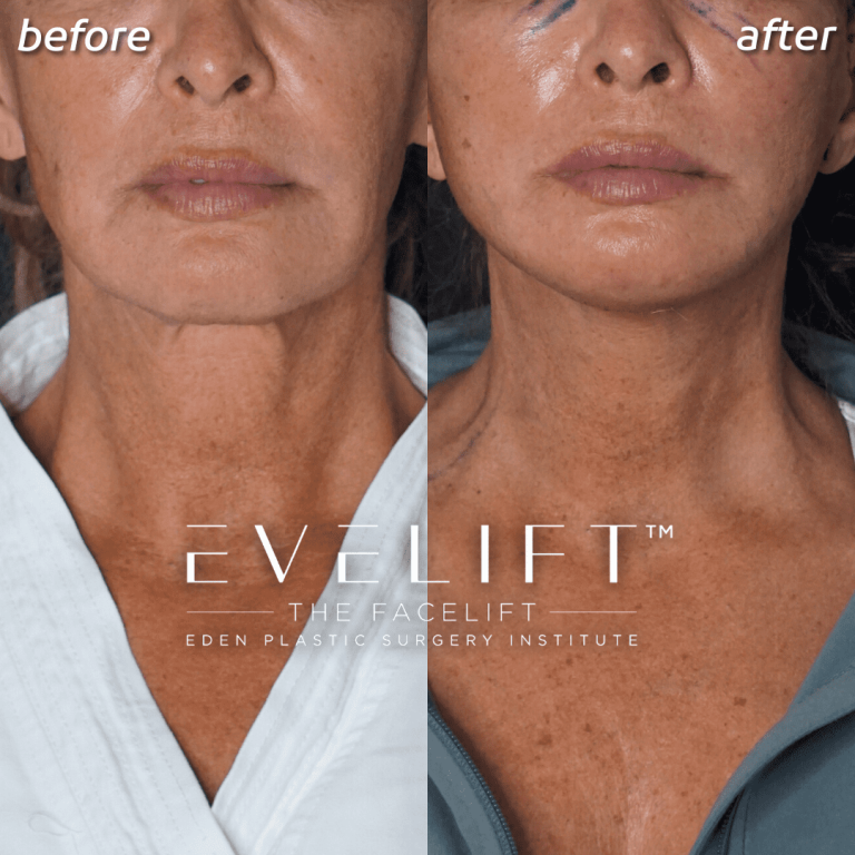 EVE Lift™️ Facelift Dr. Ali Charafeddine | South Florida Plastic Surgeon