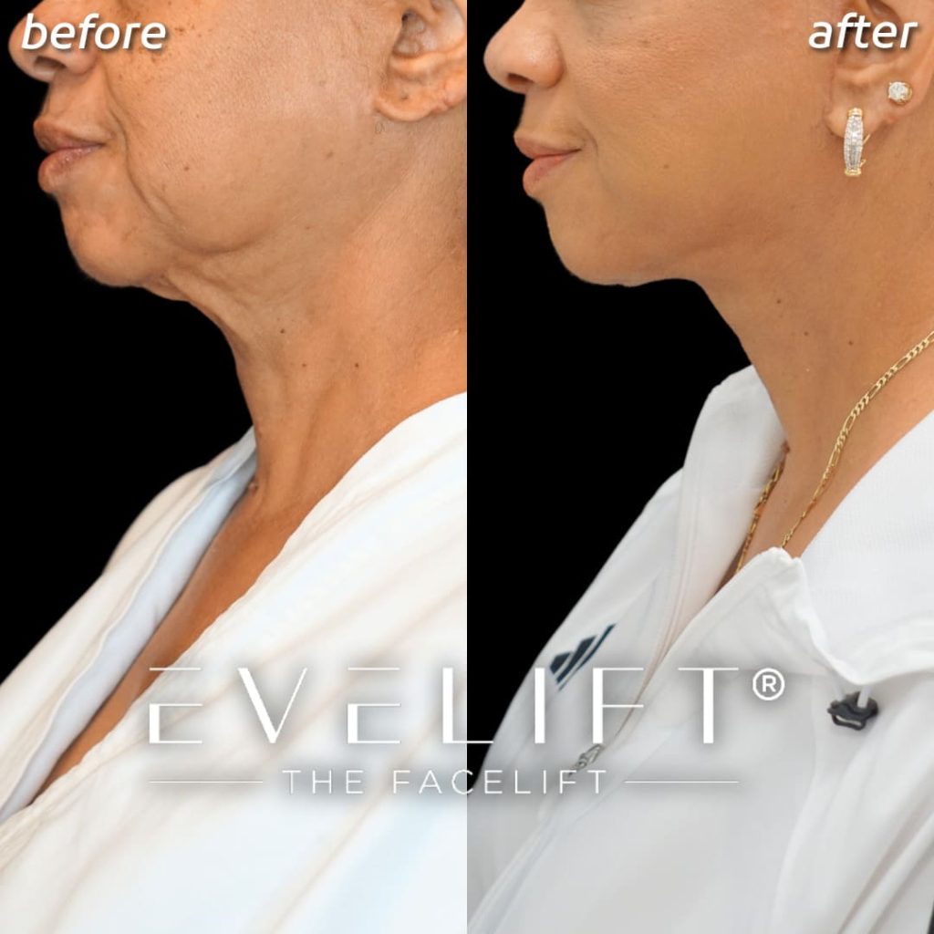 EVELift® Facelift Dr. Ali Charafeddine | South Florida Plastic Surgeon