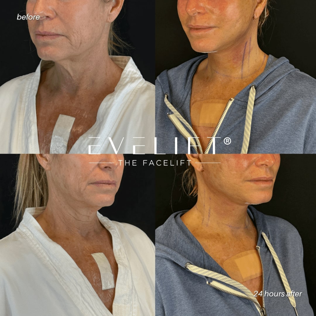 Miami Facial Plastic Surgery Before-and-after Pictures | Eden Plastic ...