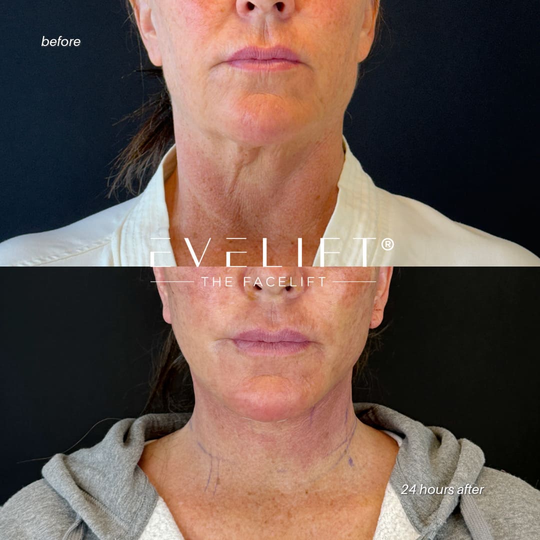 Miami Facial Plastic Surgery Before-and-after Pictures | Eden Plastic ...