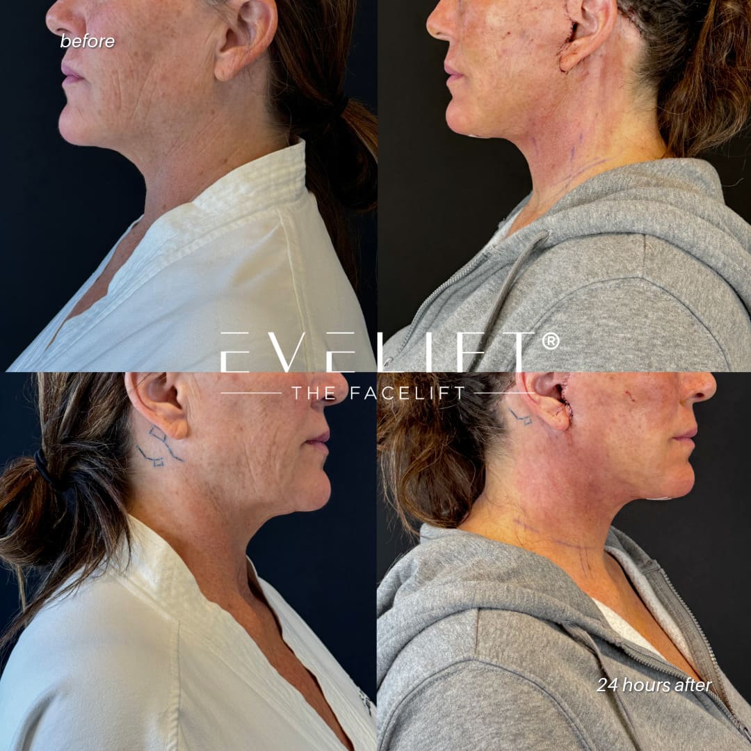 Miami Facial Plastic Surgery Before-and-after Pictures | Eden Plastic ...