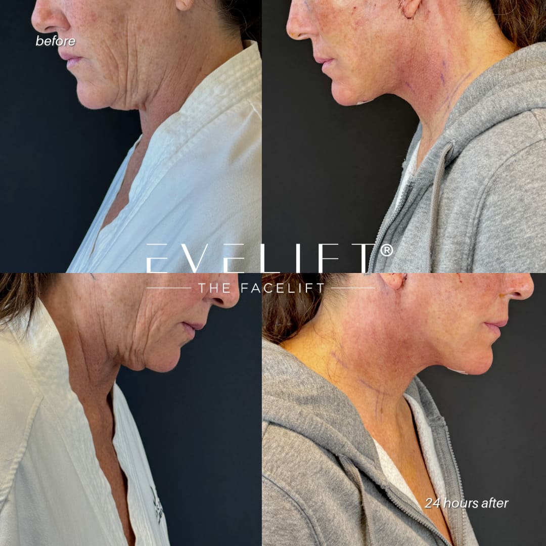 Miami Facial Plastic Surgery Before-and-after Pictures | Eden Plastic ...