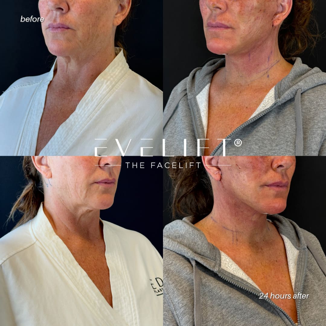 Miami Facial Plastic Surgery Before-and-after Pictures | Eden Plastic ...